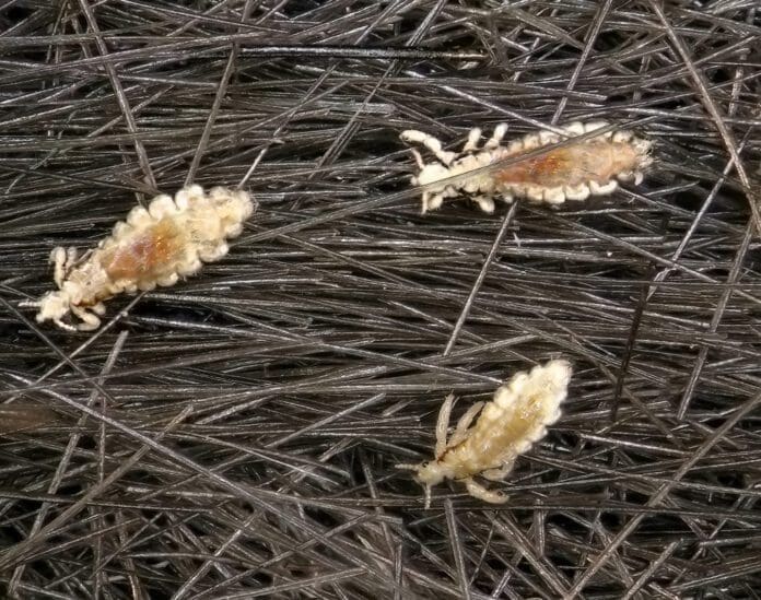 6 Popular Lice and Dandruff Differences - Icy Health