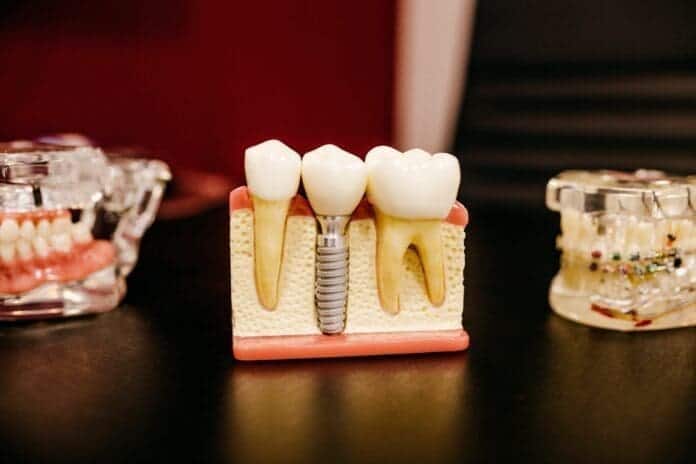 Understanding 5 Cavity Stages : A Comprehensive Guide