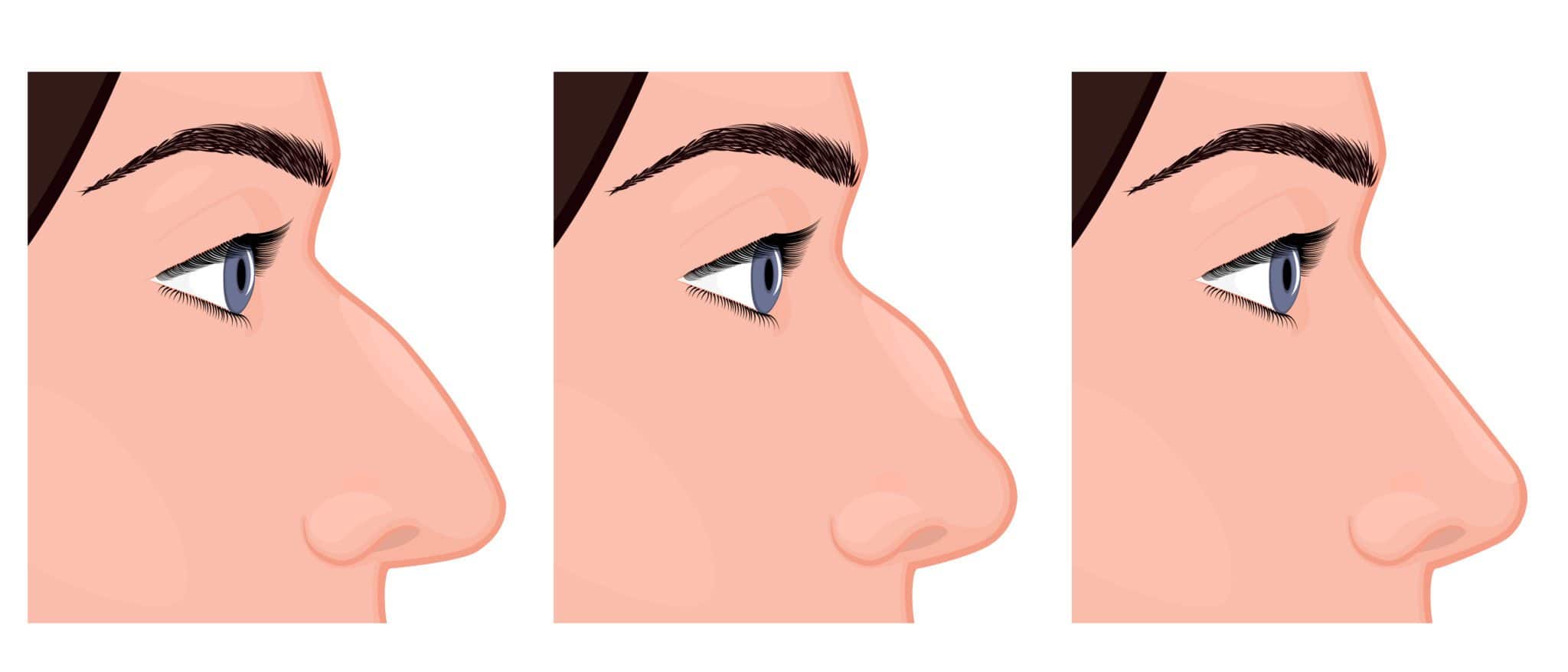 Bump On Nose Bridge: 2 Major Causes And Remedies