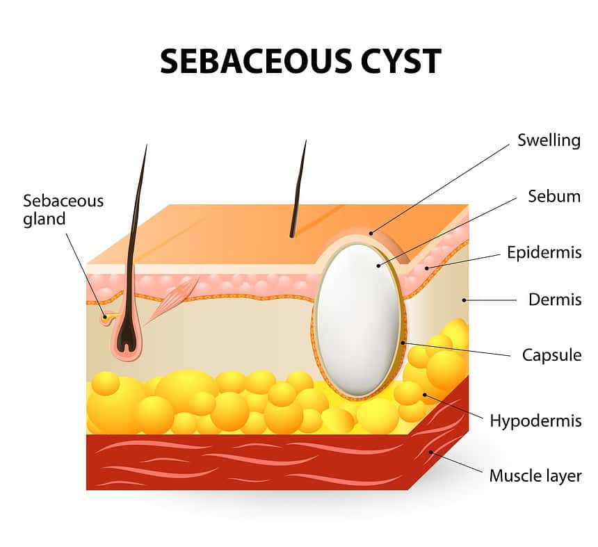 Sebaceous Cyst: Surgical Excision Techniques & More
