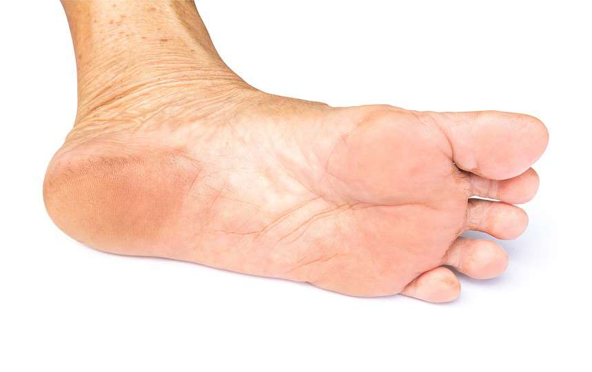 Top 7 Reasons Of Grierson Gopalan Syndrome | Causes Of Burning Feet ...