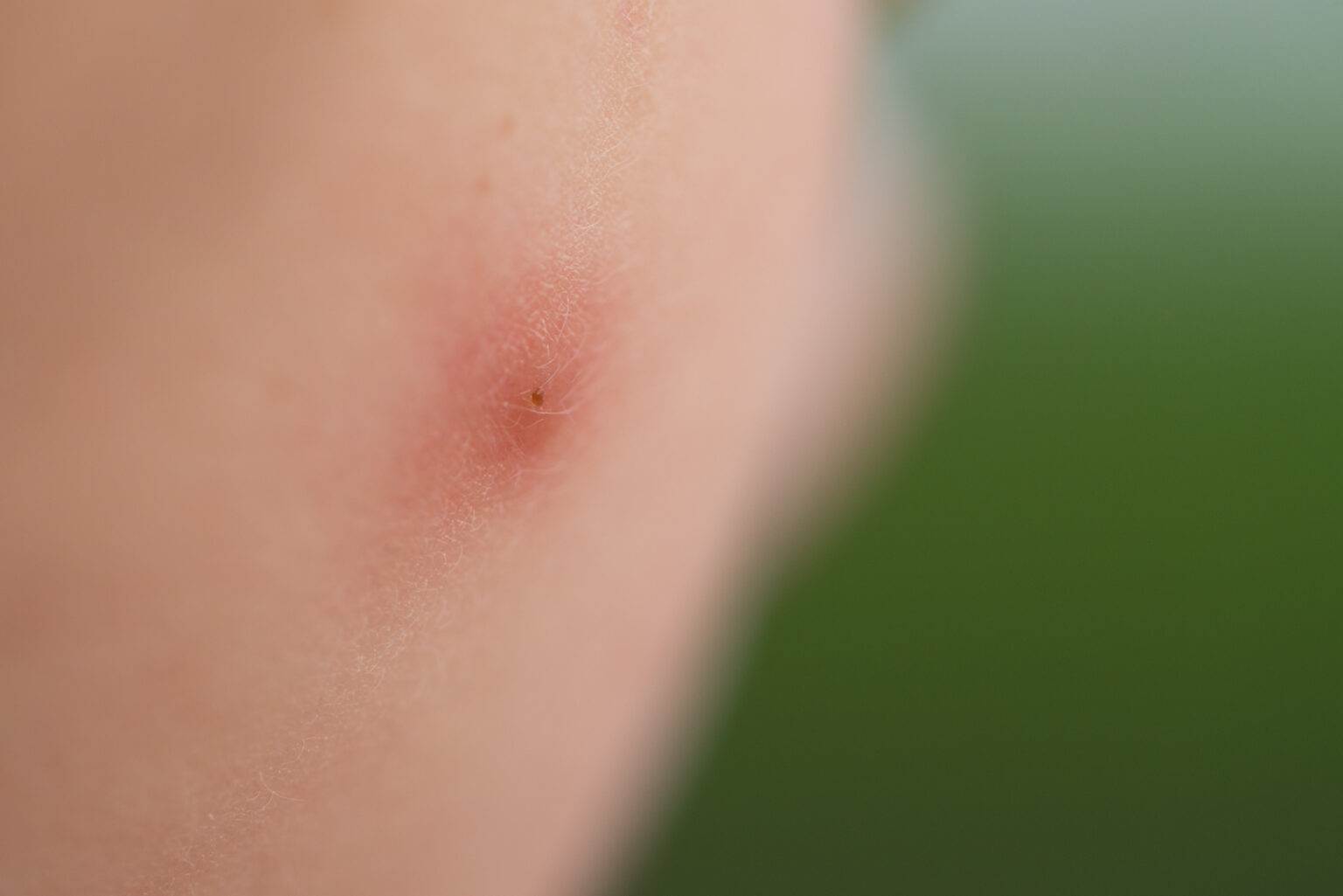 What Are Black Fly Bites? 101 Guide