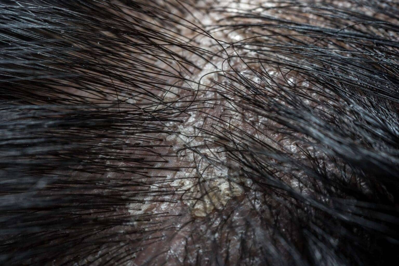 What Causes Dry Scalp? 5 Major Reasons Explained
