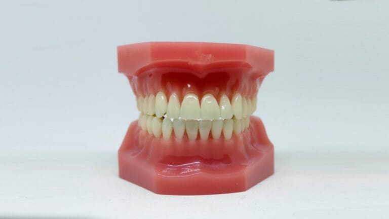 What Are Spacers For Teeth: A Detailed Guide