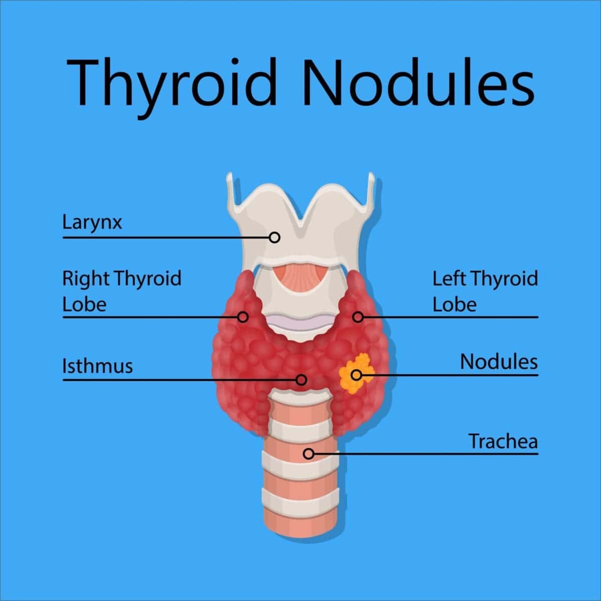 Thyroid Nodules Key Points You Should Know Thyroid Nodules Key Points You Should Know