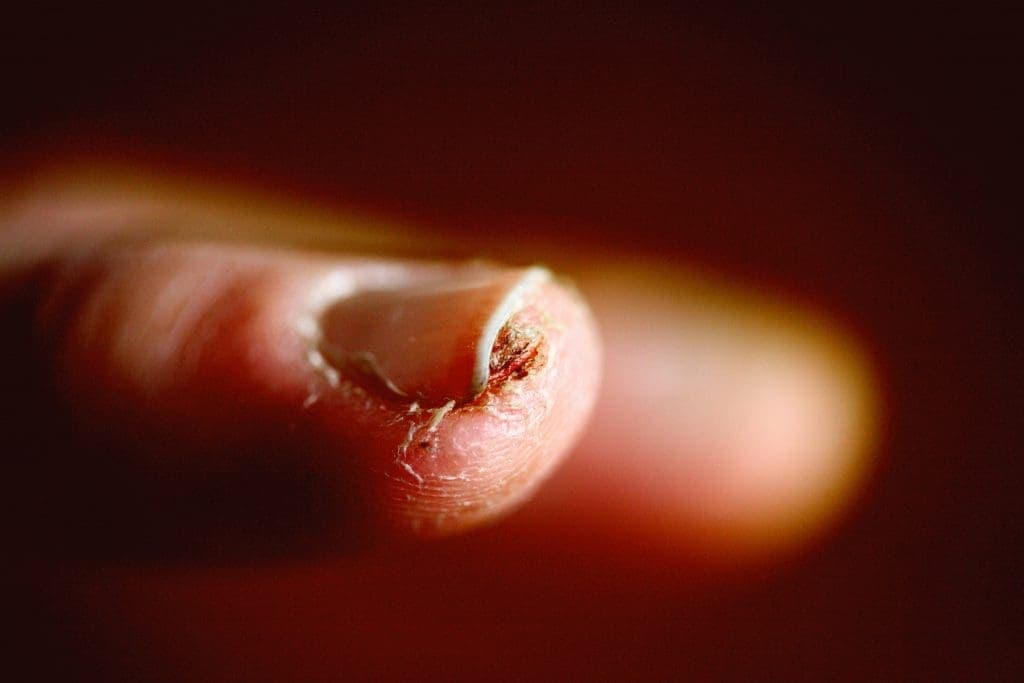 what-is-the-difference-between-eczema-and-psoriasis