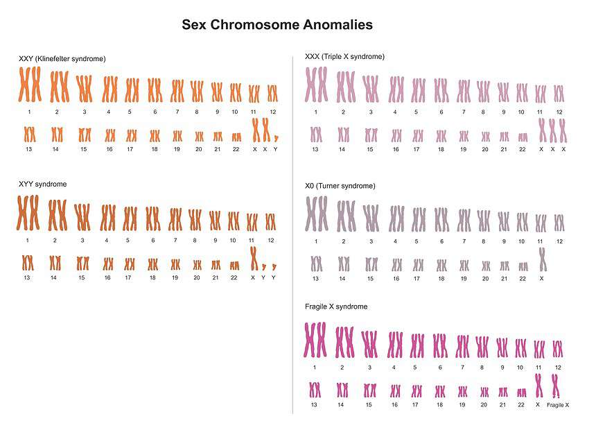 Fragile X Syndrome: Symptoms And Impact Explained