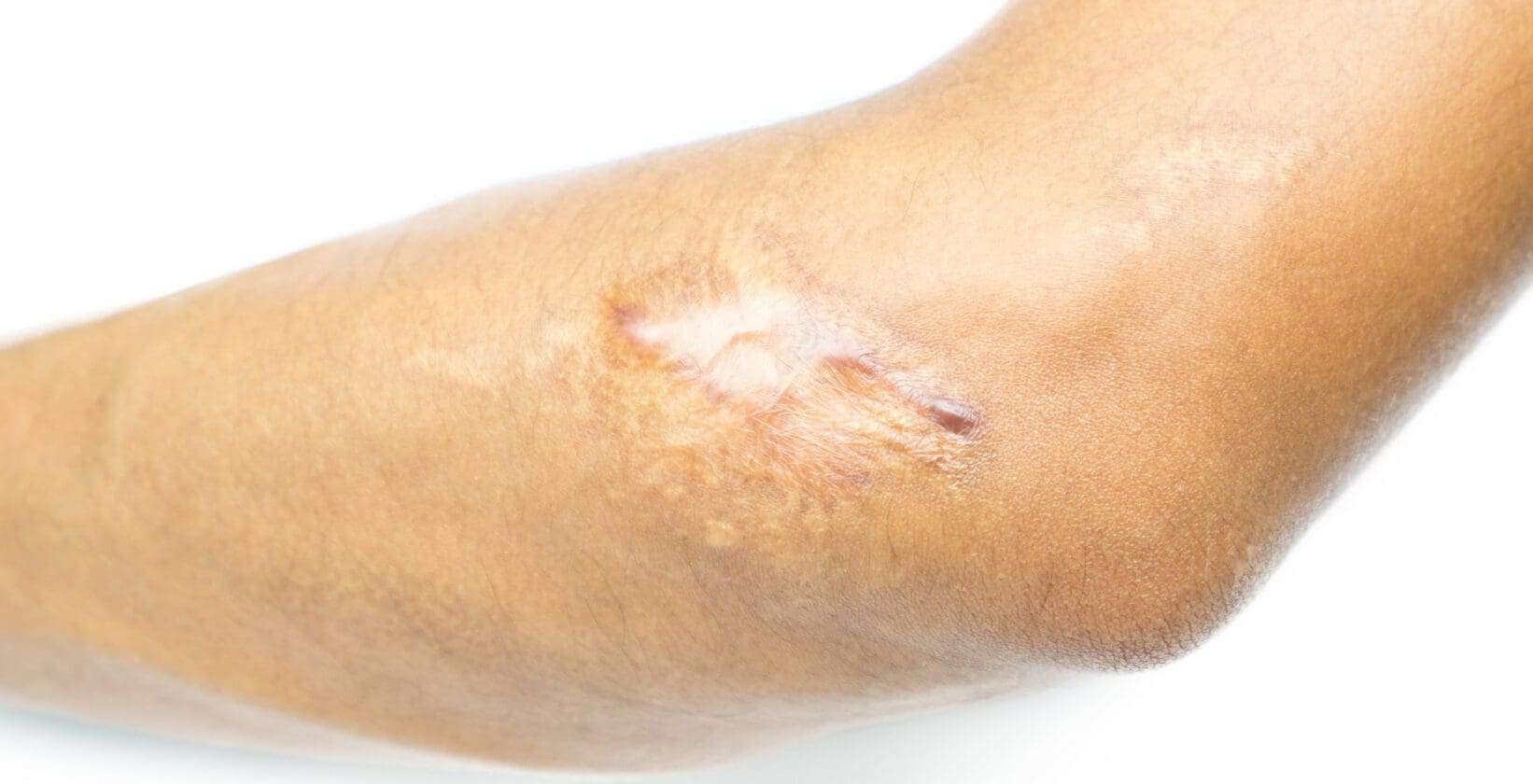 What Is Keloid: 6 Important Facts That You Must Know