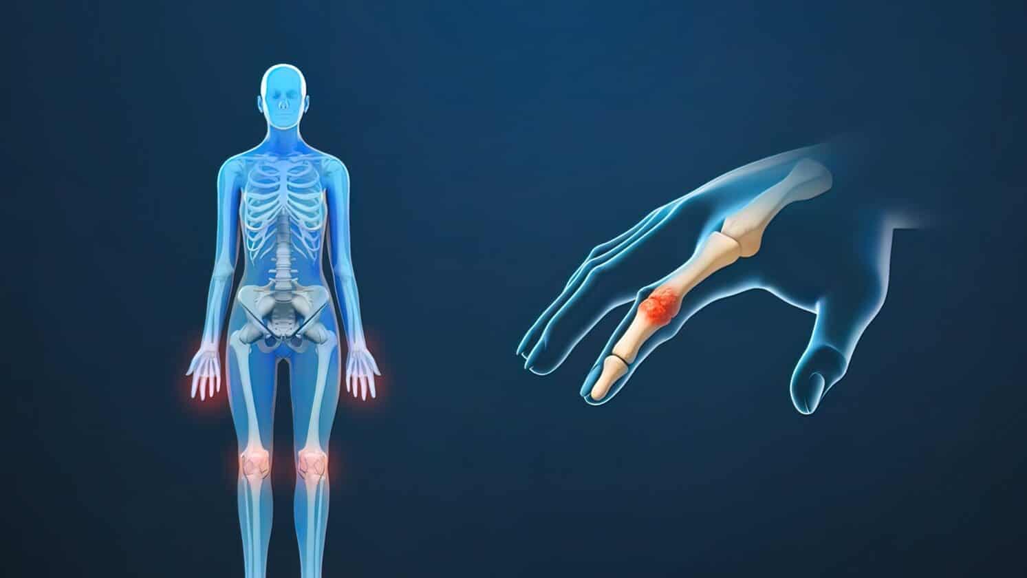 Osteo And Rheumatoid Arthritis : 7 Important Difference