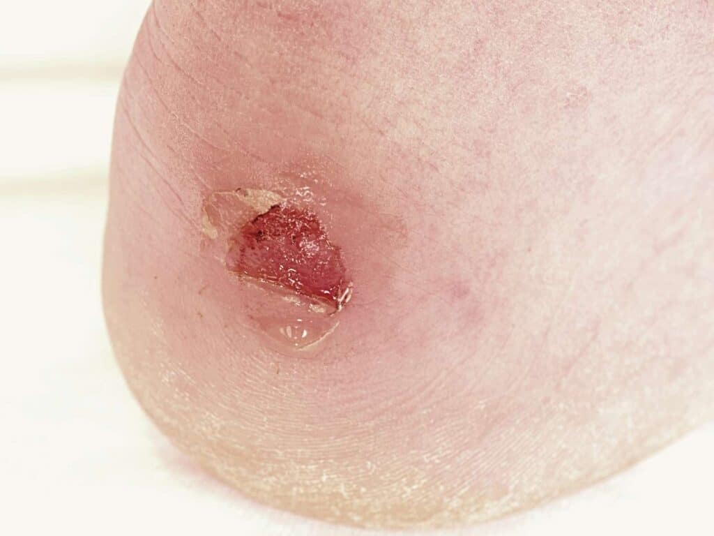 How To Prevent Blisters On Heels: 3 Types Of Blisters